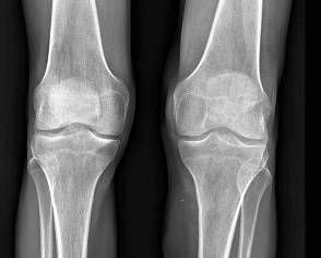 Sinovitis Vellonodular Pigmentada de la Rodilla con extensión extra ...