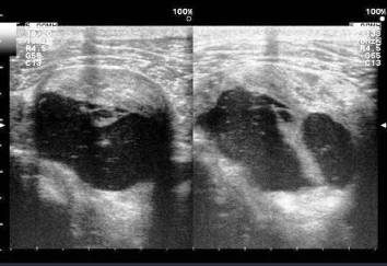 Sinovitis Vellonodular Pigmentada de la Rodilla con extensión extra ...