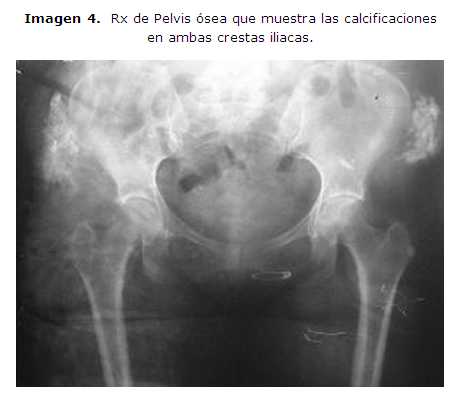 Calcinosis cutis en el curso de síndrome de Crest | Acuña Aguilarte ...