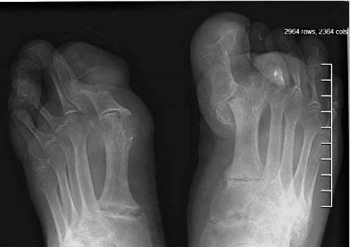 Gota en imágenes | Rodríguez Linares | Revista Cubana de Reumatología