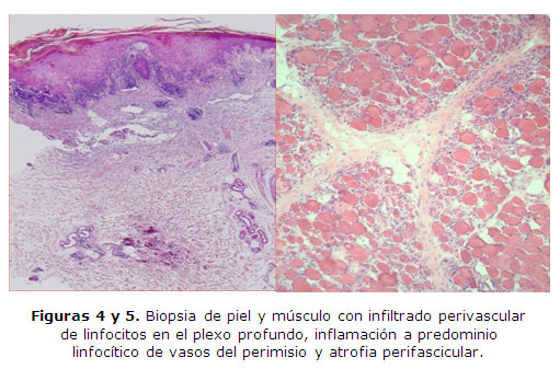 Dermatomiositis y colitis ulcerosa: una asociación infrecuente | Pila ...